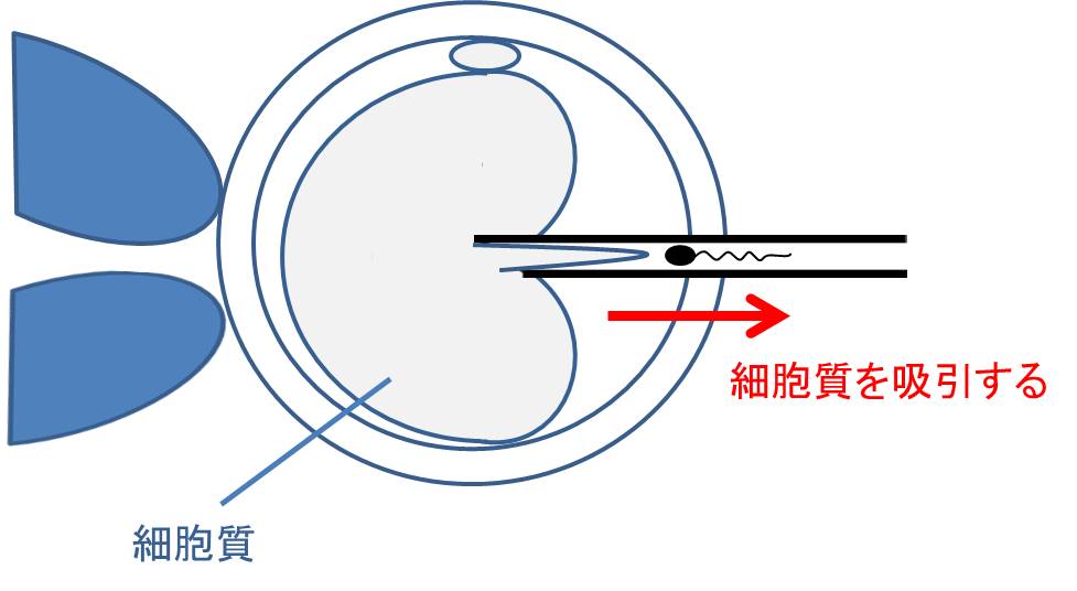 Piezo(圧電素子:piezo electric elements)を使用した顕微授精(Piezo-ICSI)をご存じですか？(2016年3 ...